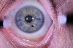 Meaning of Eye Pigments – Iridology by Peppy